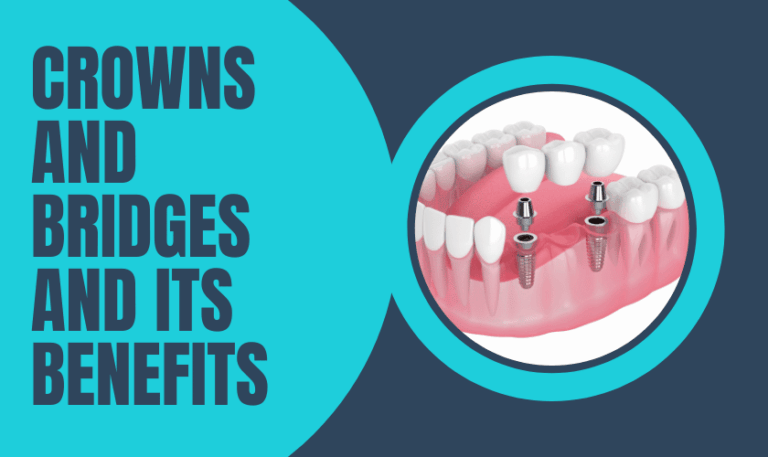 Types of Crowns and Bridges and its Benefits