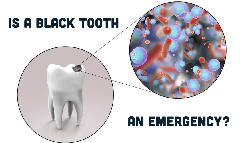 Is a Black Tooth an Emergency? Find Out Now!